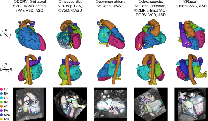 HVSMR-2.0: A 3D cardiovascular MR dataset for whole-heart segmentation in congenital heart ...