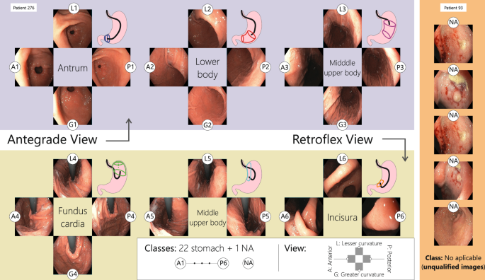 GastroHUN an Endoscopy Dataset of Complete Systematic Screening ...