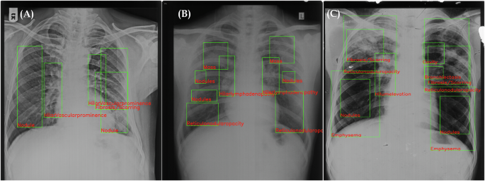 Silicodata: An Annotated Benchmark CXR Dataset for Silicosis Detection | Scientific Data