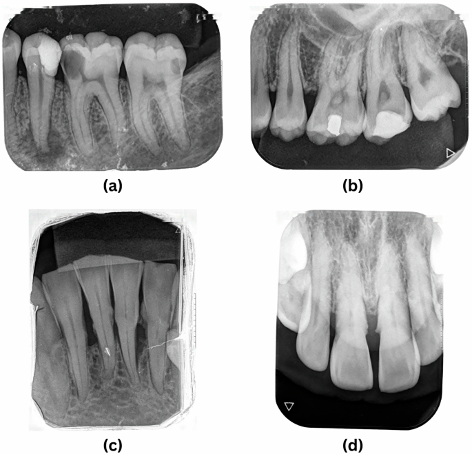 DenPAR: Annotated Intra-Oral Periapical Radiographs Dataset for Machine ...