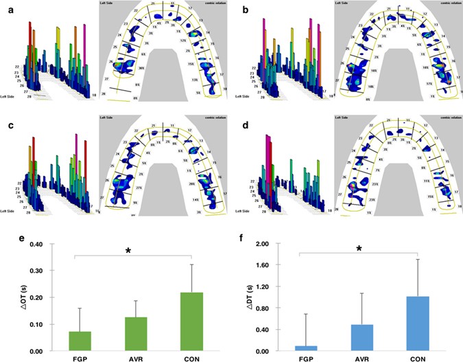 Occlusion and Disocclusion Time Changes in Single Unit Crowns Designed ...
