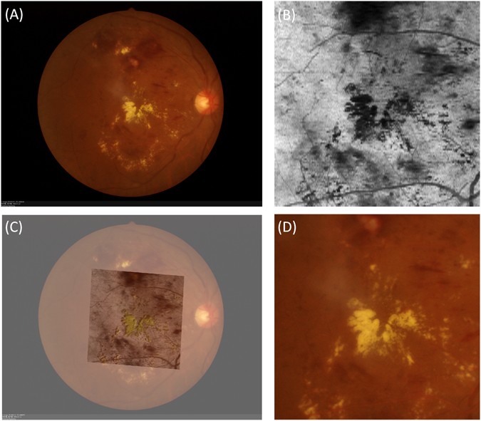 Multimodality analysis of Hyper-reflective Foci and Hard Exudates in ...