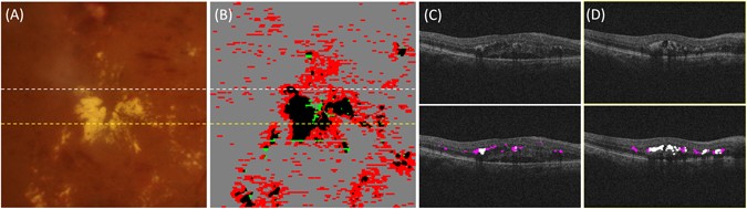 Multimodality analysis of Hyper-reflective Foci and Hard Exudates in ...