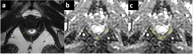 Paradoxical puborectalis syndrome on diffusion-weighted imaging: a ...