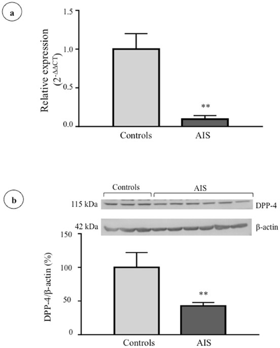 Dipeptidyl Peptidase-4 and Adolescent Idiopathic Scoliosis: Expression ...