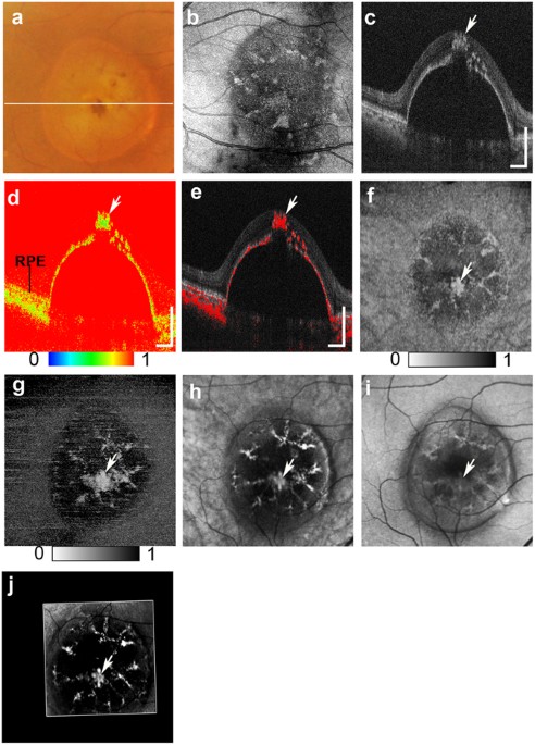 Evaluation of intraretinal migration of retinal pigment epithelial ...