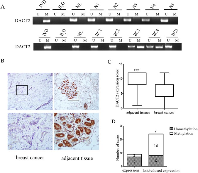 Methylation of DACT2 promotes breast cancer development by activating ...