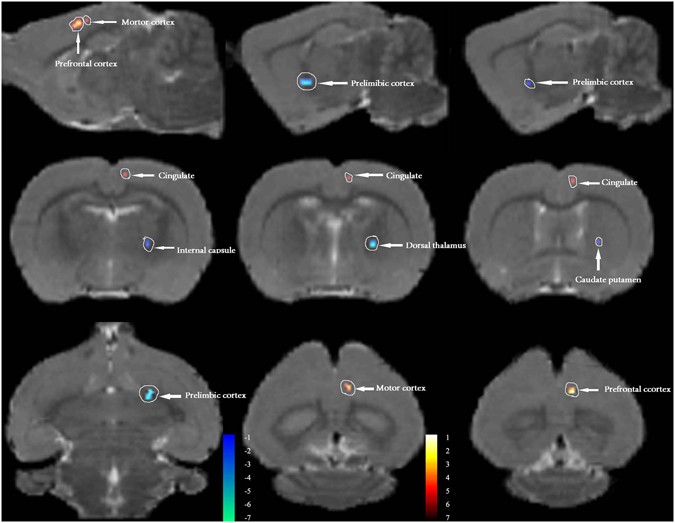 Disrupted functional connectivity between the periaqueductal gray and ...
