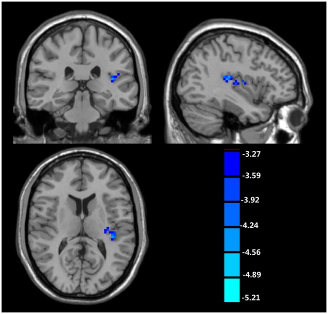 Altered Spontaneous Brain Activity in Children with Early Tourette ...