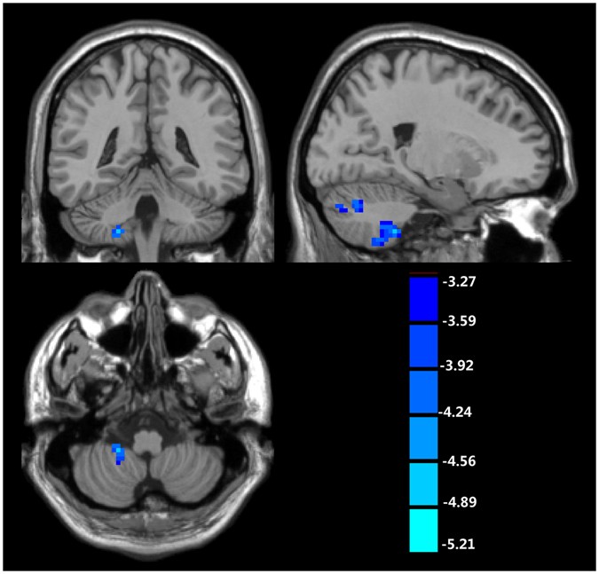 Altered Spontaneous Brain Activity in Children with Early Tourette ...
