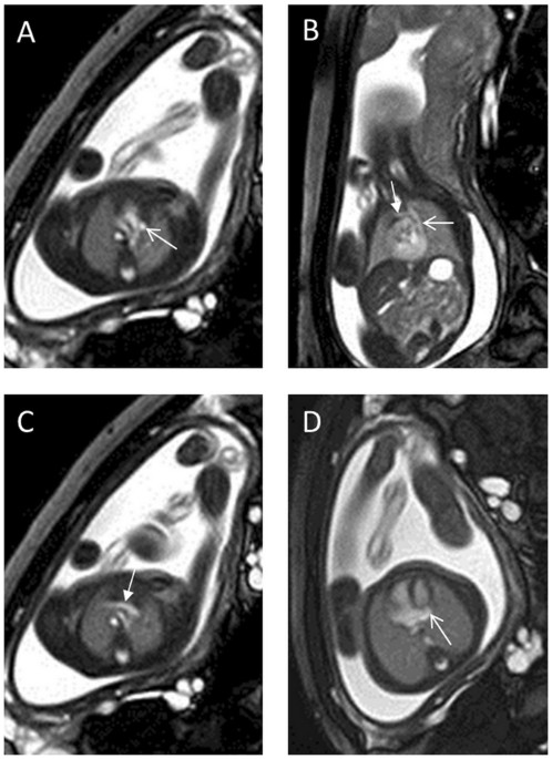 Magnetic resonance imaging of fetal persistent left superior vena cava ...