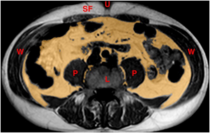 Normalized periprostatic fat MRI measurements can predict prostate ...
