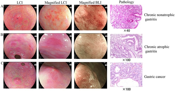 Linked colour imaging benefits the endoscopic diagnosis of distal ...