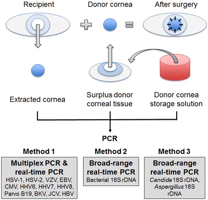 Multiplex polymerase chain reaction for pathogen detection in donor/recipient corneal transplant ...