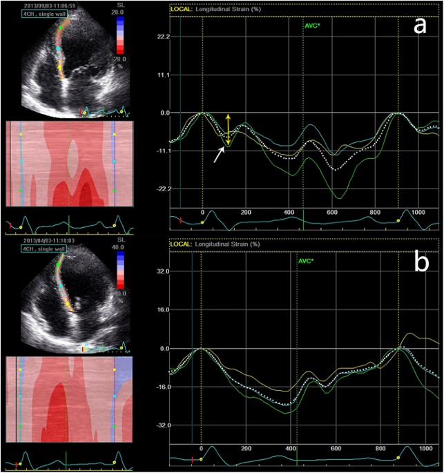 Effect of septal flash on right ventricular systolic function in left ...