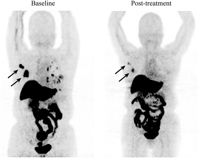 A preliminary study of 18 F-FES PET/CT in predicting metastatic breast ...