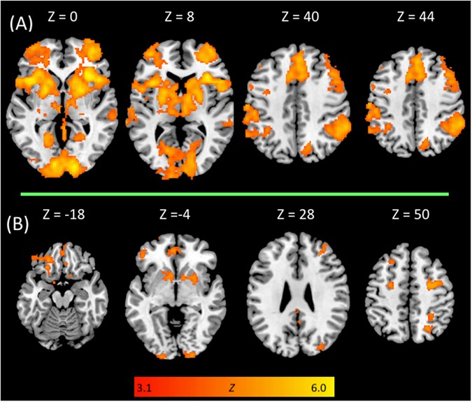 Neural correlates of proactive and reactive motor response inhibition ...