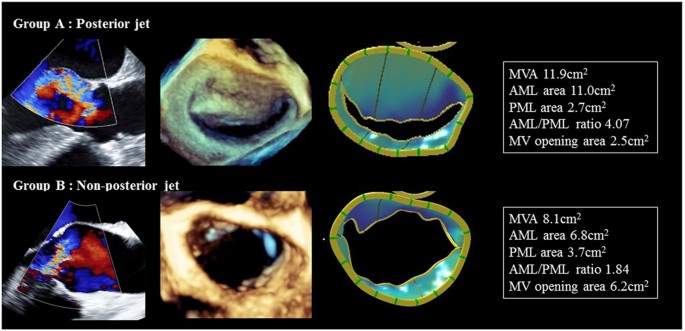 Effect of aortic regurgitant jet direction on mitral valve leaflet ...