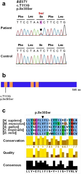 Adult-Onset Vitelliform Macular Dystrophy caused by BEST1 p.Ile38Ser ...