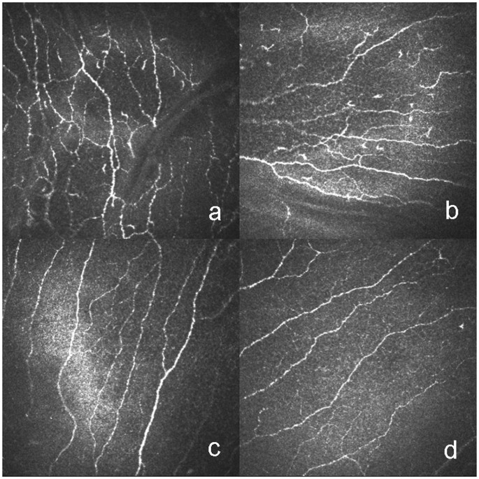 In Vivo Confocal Microscopy Evaluation of Ocular Surface with Graft ...