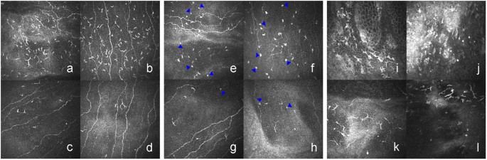 In Vivo Confocal Microscopy Evaluation of Ocular Surface with Graft ...