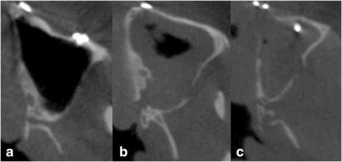 The pterygomaxillary junction: An imaging study for surgical ...