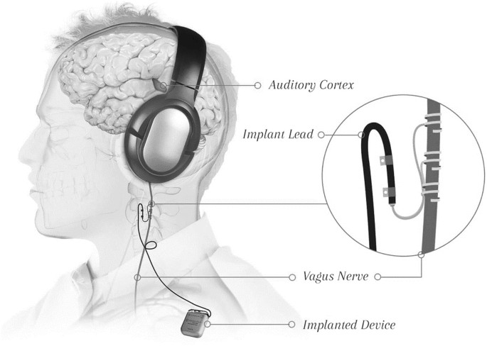 Vagus Nerve Stimulation Paired with Tones for the Treatment of Tinnitus: A Prospective ...
