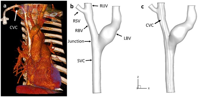 Numerical Simulation of Hemodynamic Changes in Central Veins after ...