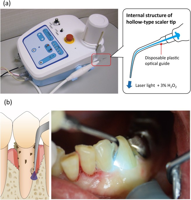 Adjunctive antimicrobial chemotherapy based on hydrogen peroxide ...