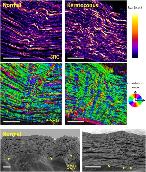 Stromal striae: a new insight into corneal physiology and mechanics ...