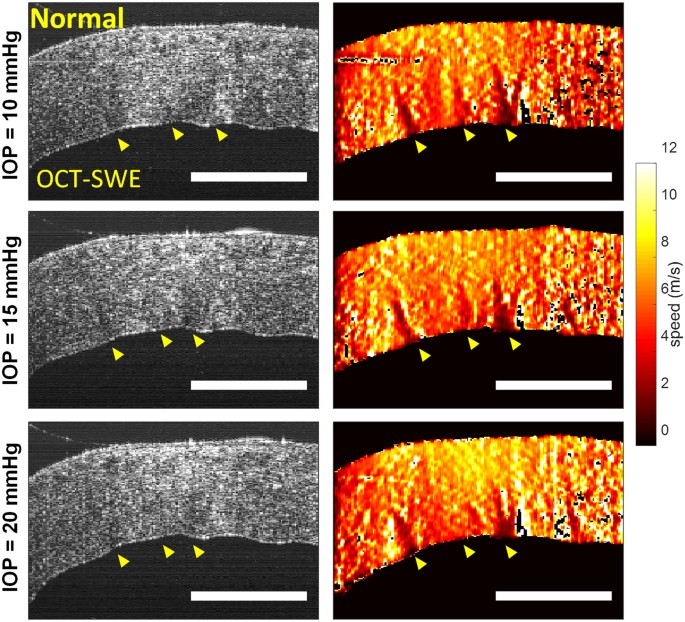 Stromal striae: a new insight into corneal physiology and mechanics ...