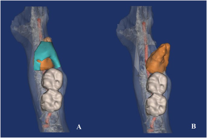Mesiolingual root rotation for horizontal mandibular third molar ...