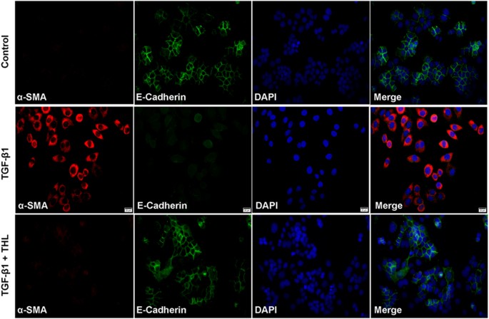 Thalidomide Inhibits TGF-β1-induced Epithelial to Mesenchymal ...