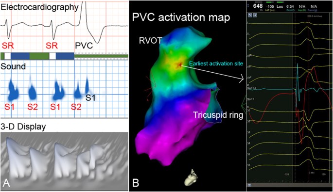 Predicting the Origin of Ventricular Arrhythmia Using Acoustic ...