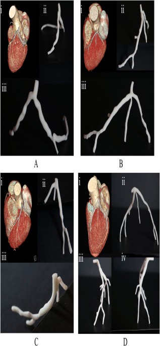 Impact of spatial characteristics in the left stenotic coronary artery ...