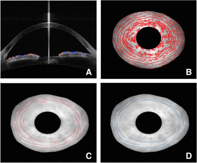 Automated Detection of Iris Furrows and their Influence on Dynamic Iris Volume Change ...