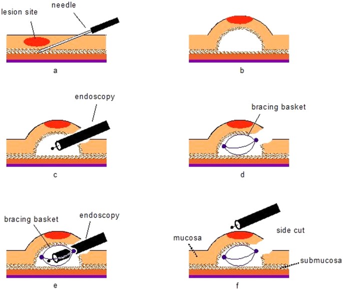 Endoscopic submucosal tunnel dissection using a novel bracing basket: An animal feasibility ...