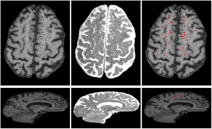 Perivascular Spaces Segmentation in Brain MRI Using Optimal 3D ...