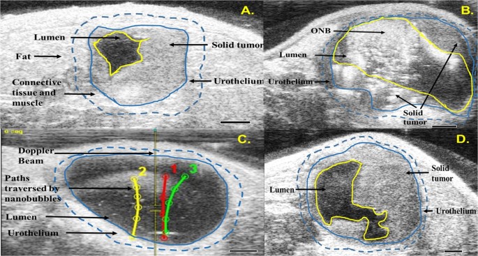 Ultrasound beam steering of oxygen nanobubbles for enhanced bladder ...
