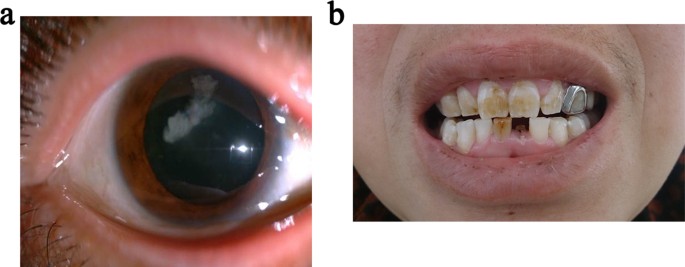 A novel small deletion in the NHS gene associated with Nance-Horan ...
