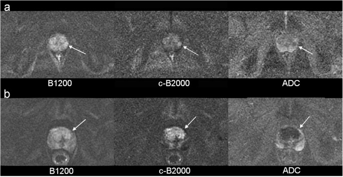 The impact of computed high b-value images on the diagnostic accuracy ...