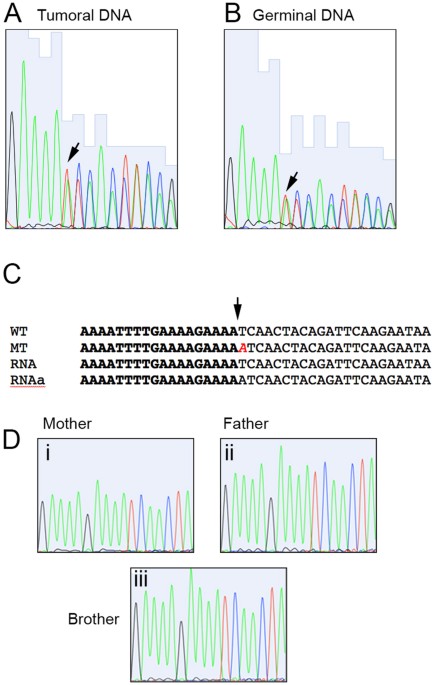 Genomics of a pediatric ovarian fibrosarcoma. Association with the ...