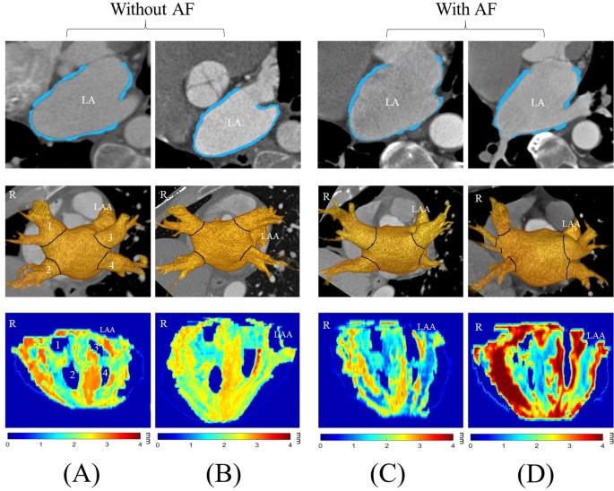 Left Atrium Wall-mapping Application for Wall Thickness Visualisation ...