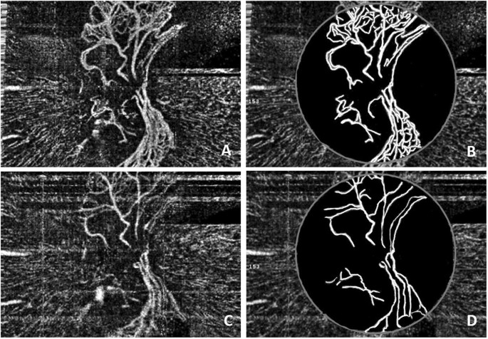 Observation of optic disc neovascularization using OCT angiography in ...