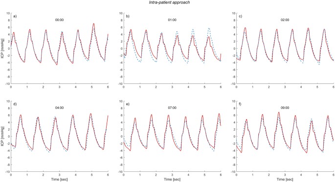 Non-invasive Estimation of the Intracranial Pressure Waveform from the ...