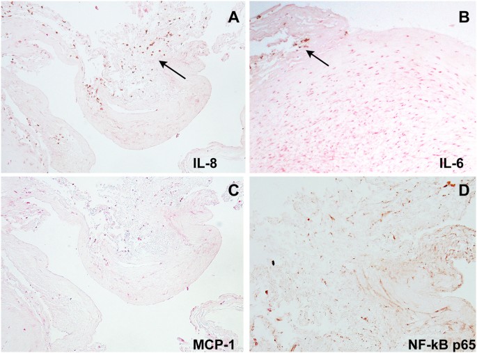 High-resolution Imaging of Myeloperoxidase Activity Sensors in Human ...
