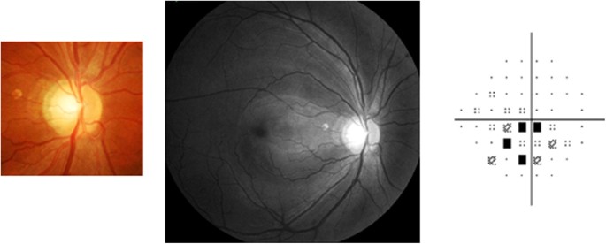 Systemic Vascular Risk Factors for Multiple Retinal Nerve Fiber Layer ...