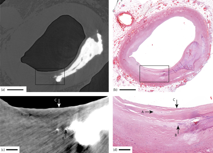 Cellular-resolution 3D virtual histology of human coronary arteries using x-ray phase tomography ...