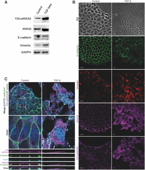 Annexin A2 overexpression associates with colorectal cancer ...