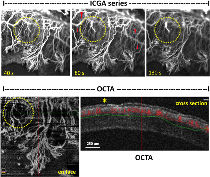 Comparison of Optical Coherence Tomography Angiography to Indocyanine ...